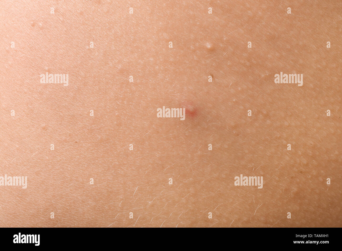 Human skin with acne, closeup Stock Photo - Alamy