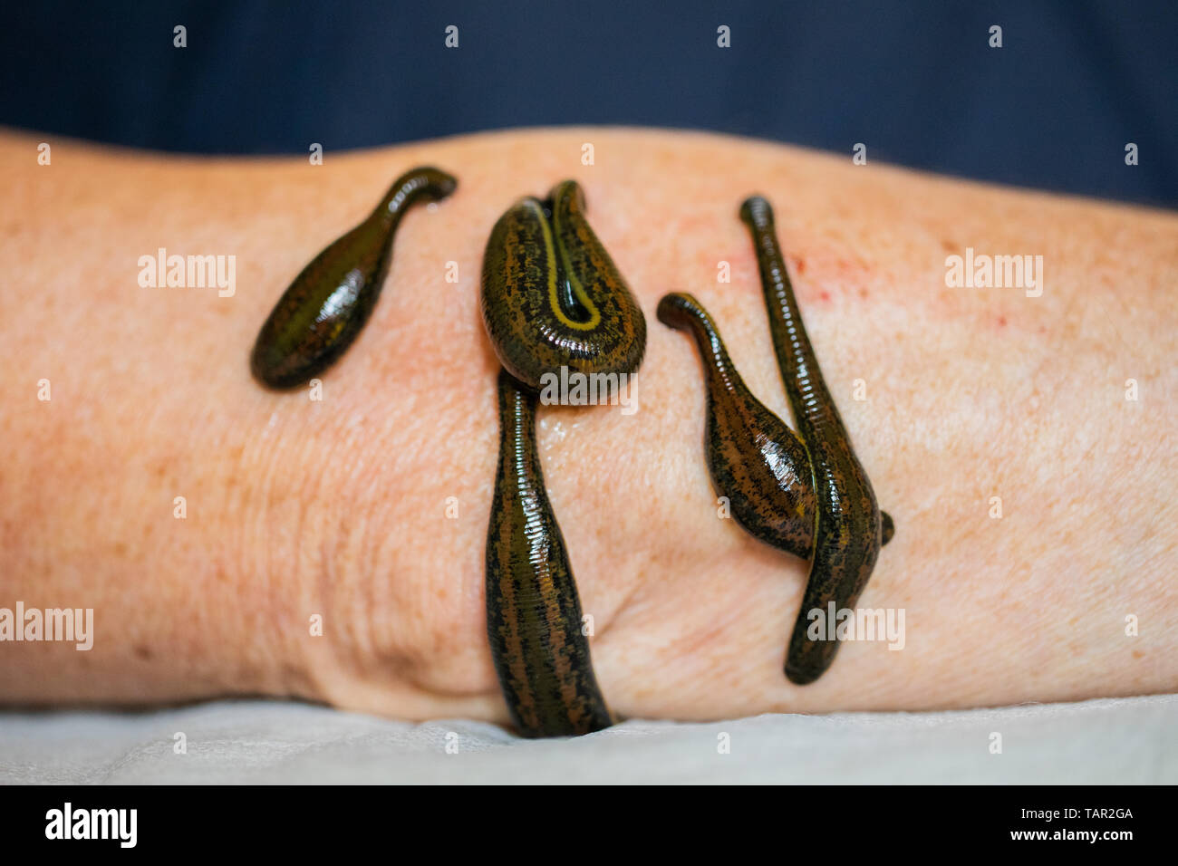 Leech on arm hi-res stock photography and images - Alamy