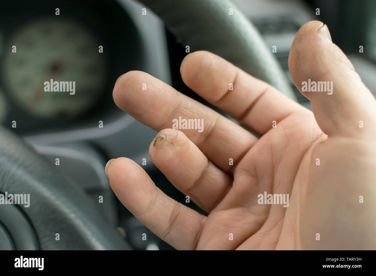 Hand of a man with a missing finger phalanx on the background of the ...