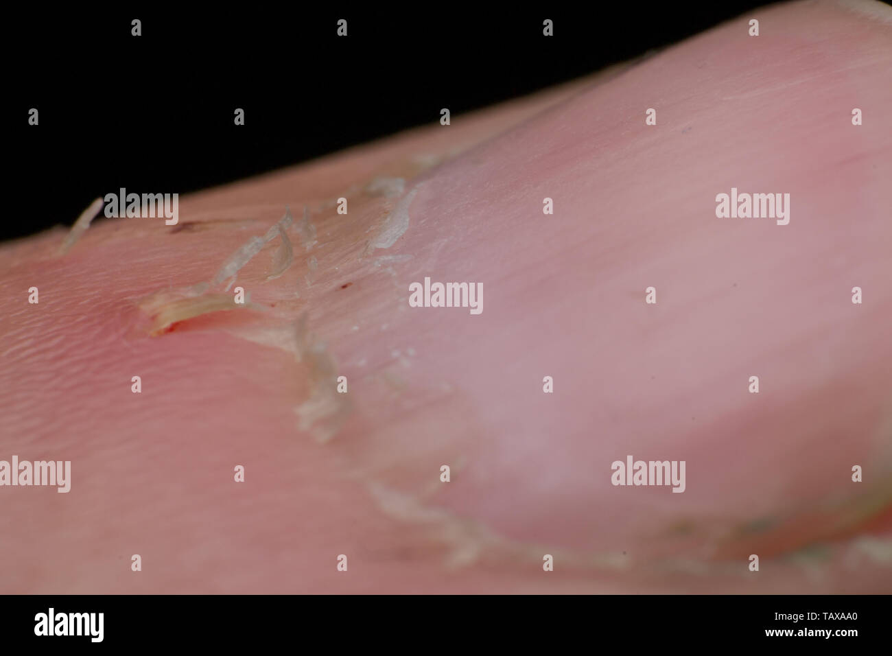 Chapped skin hi-res stock photography and images - Alamy