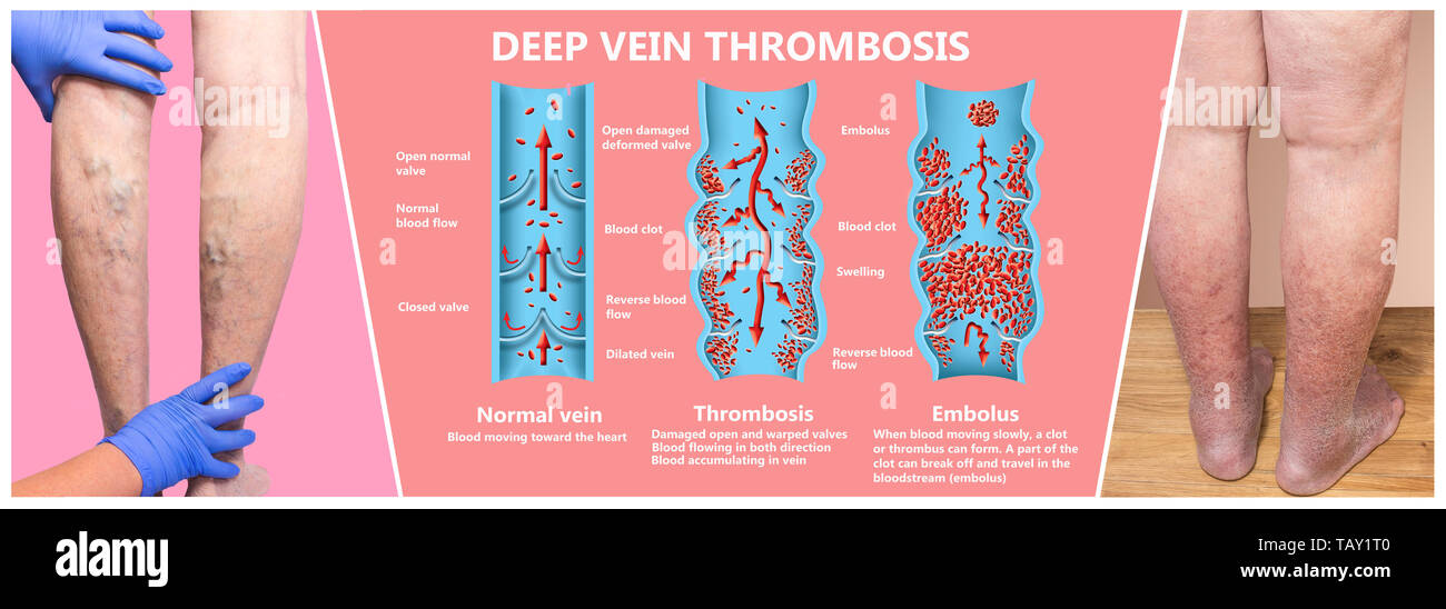 Deep Vein Thrombosis High Resolution Stock Photography and Images - Alamy