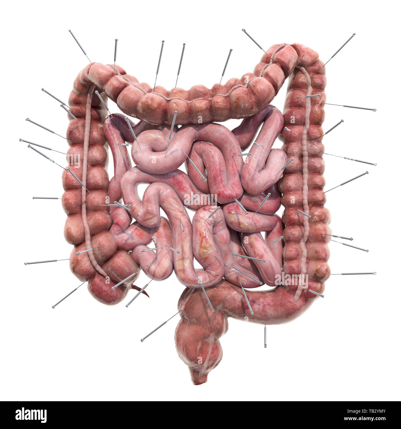Human bowel with acupuncture needles. Acupuncture treatment of ...