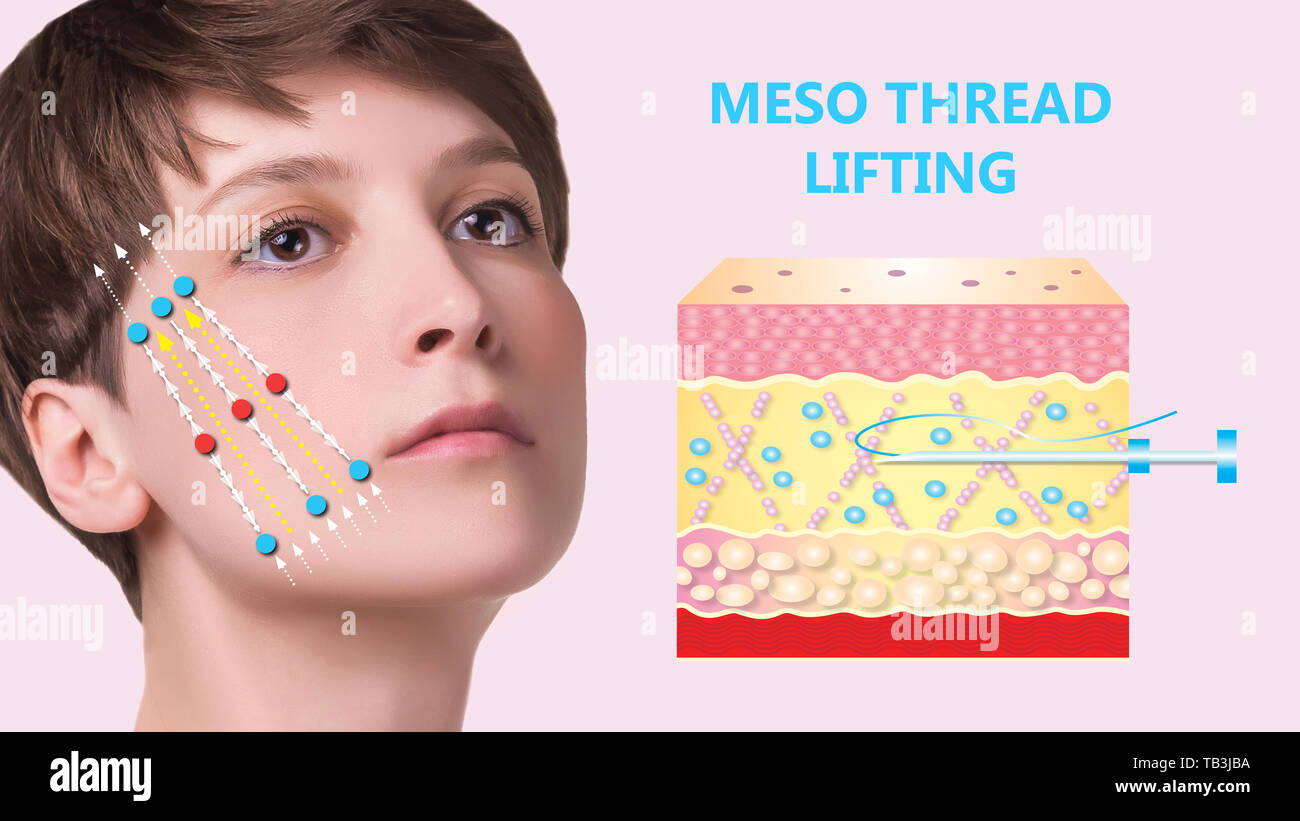 Thread Lift. Lifting by threads concept Stock Photo - Alamy