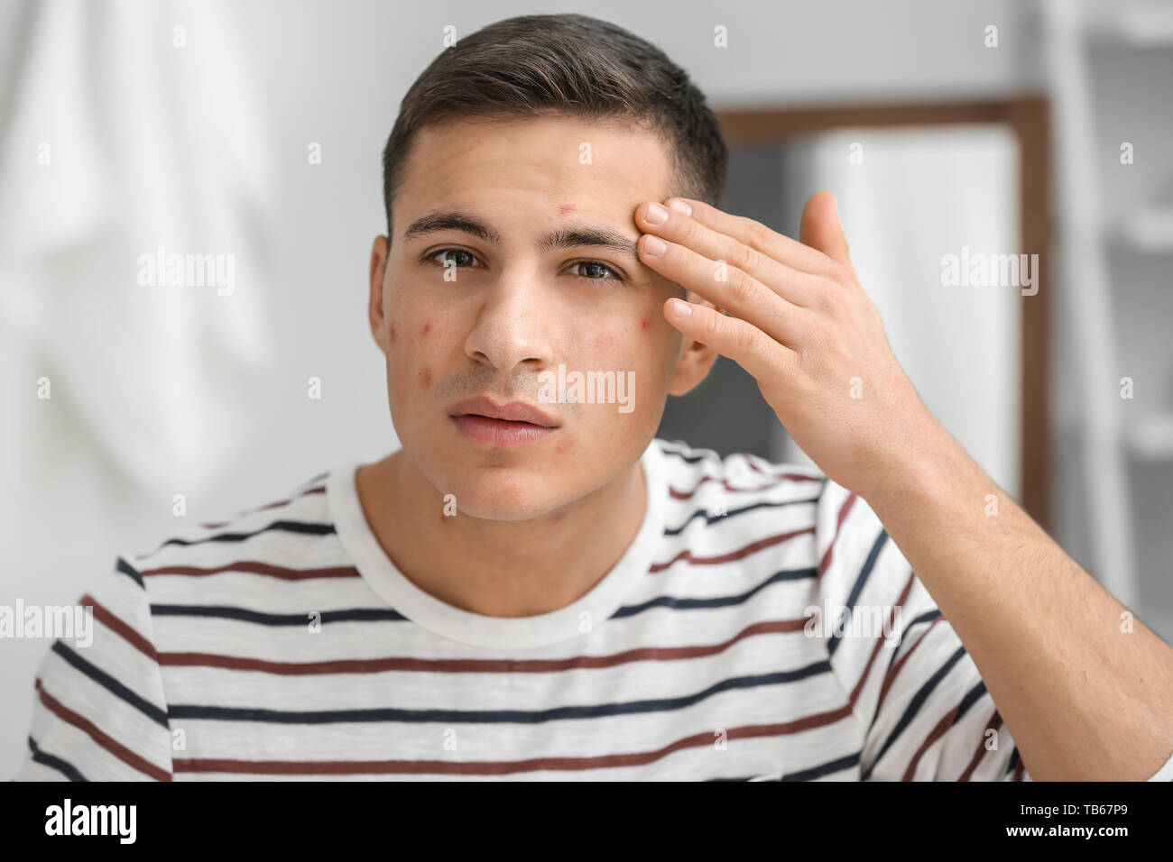 Man with acne hi-res stock photography and images - Alamy