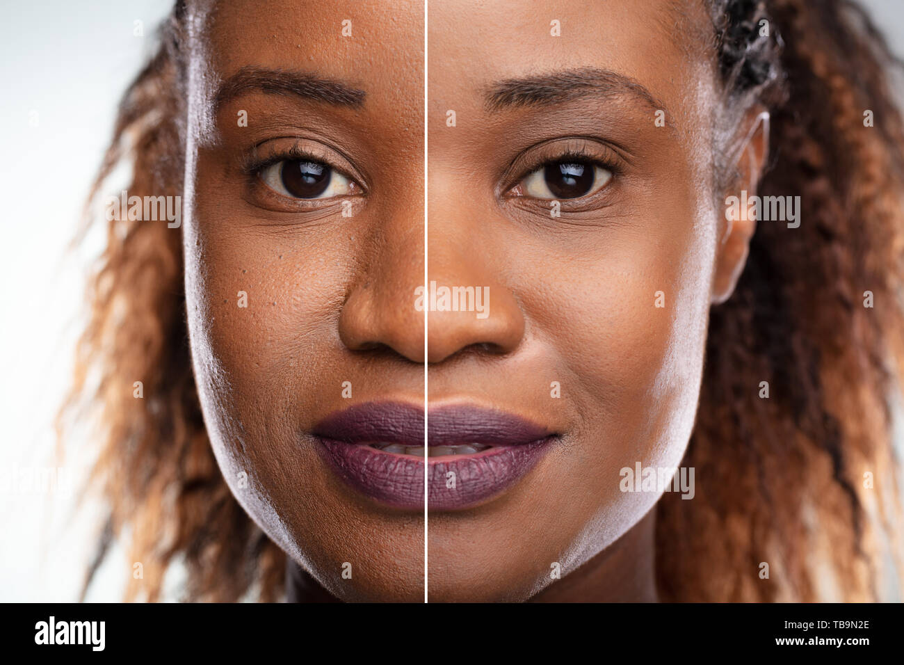 Close-up Of A Young Woman's Face Before And After Cosmetic Procedure ...