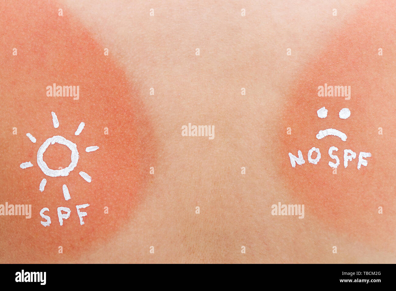 Skin Burnt High Resolution Stock Photography and Images - Alamy