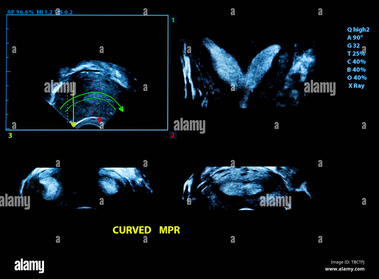 Colourful image of modern ultrasound monitor. Ultrasonography machine ...