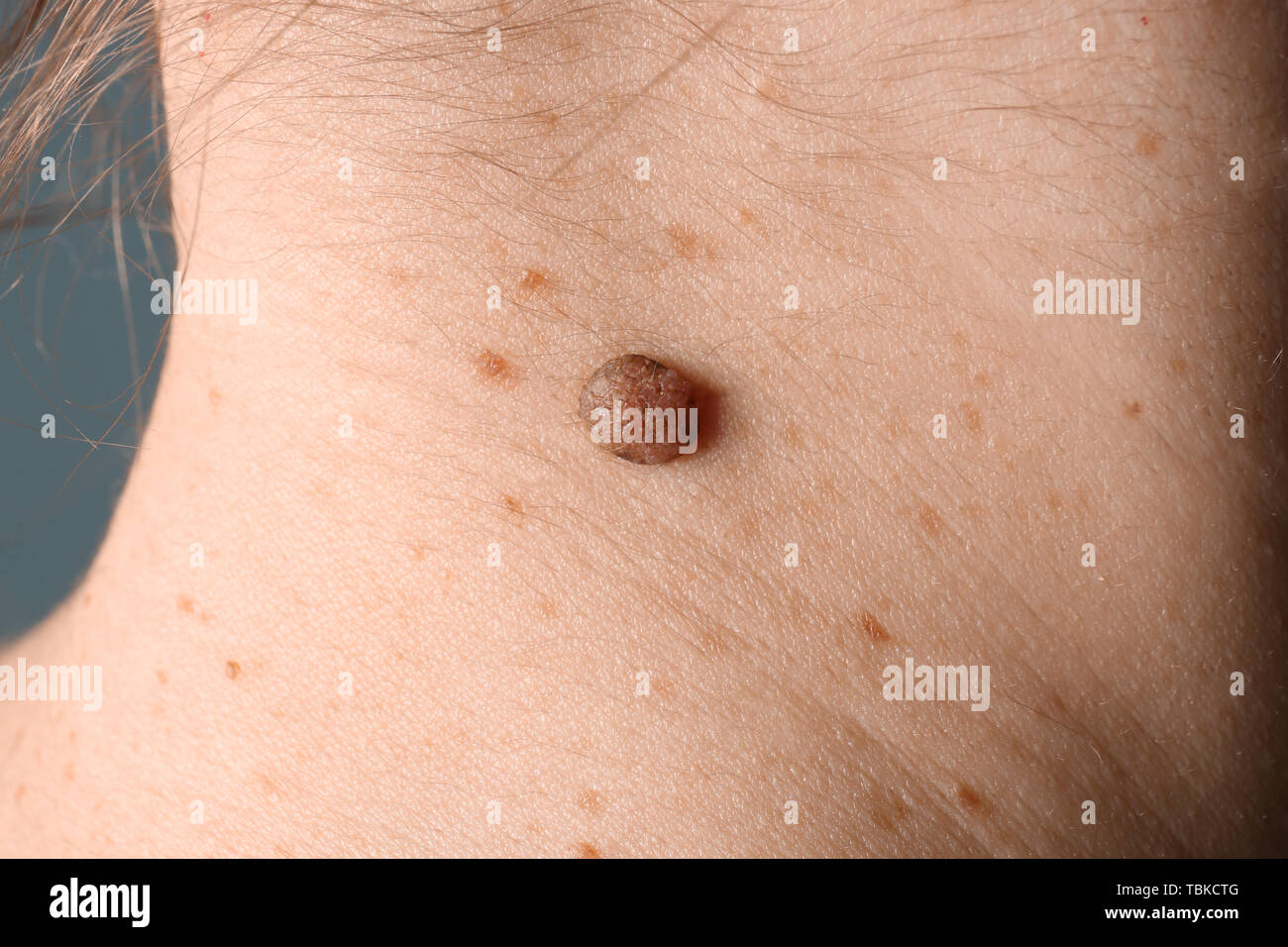 Skin cancer moles woman hi-res stock photography and images - Alamy