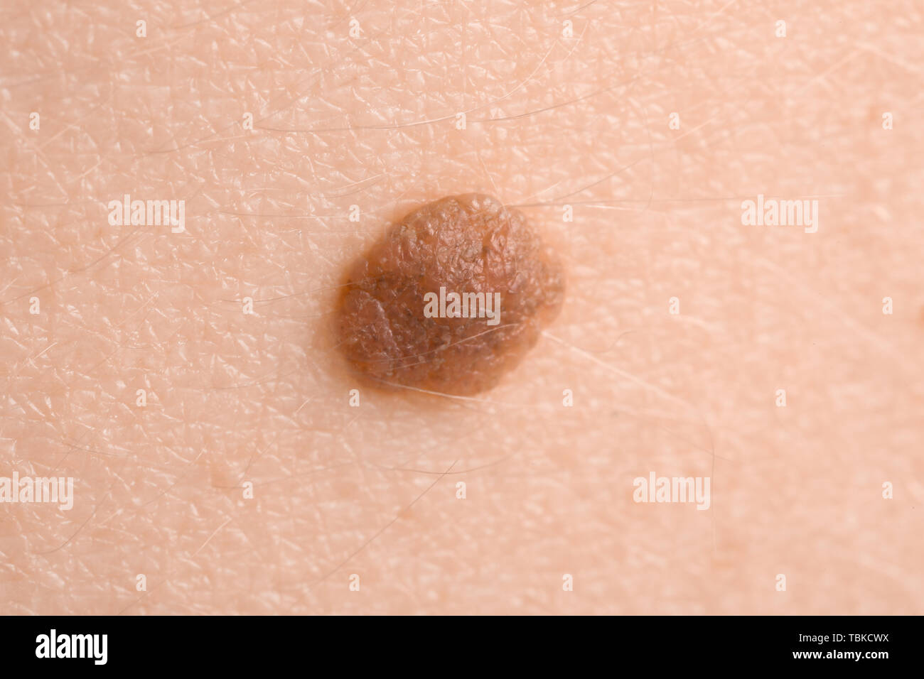 Human mole hi-res stock photography and images - Alamy