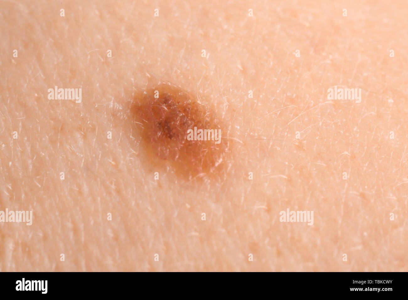 Human Mole High Resolution Stock Photography and Images - Alamy