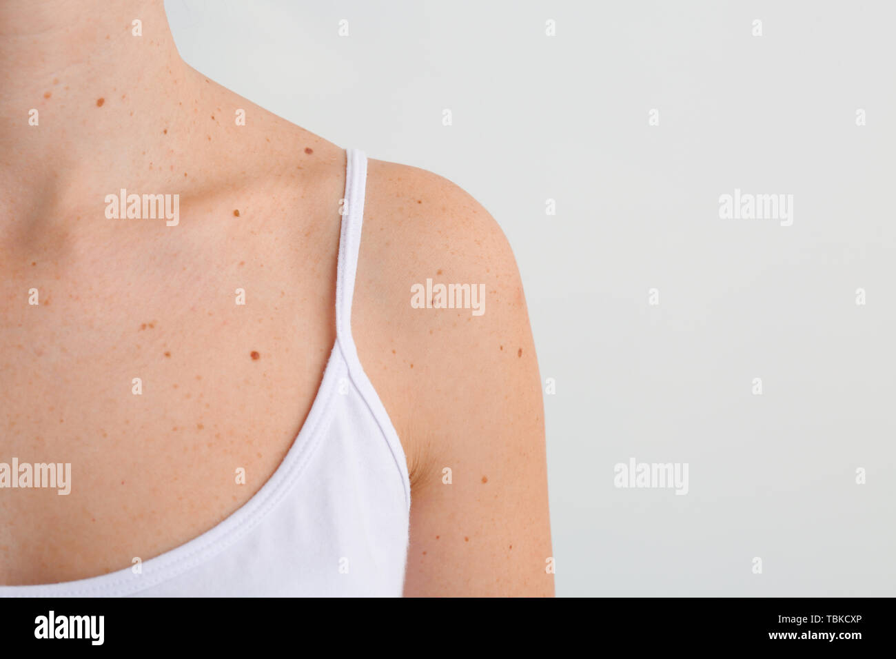 Young woman with moles on light background Stock Photo - Alamy