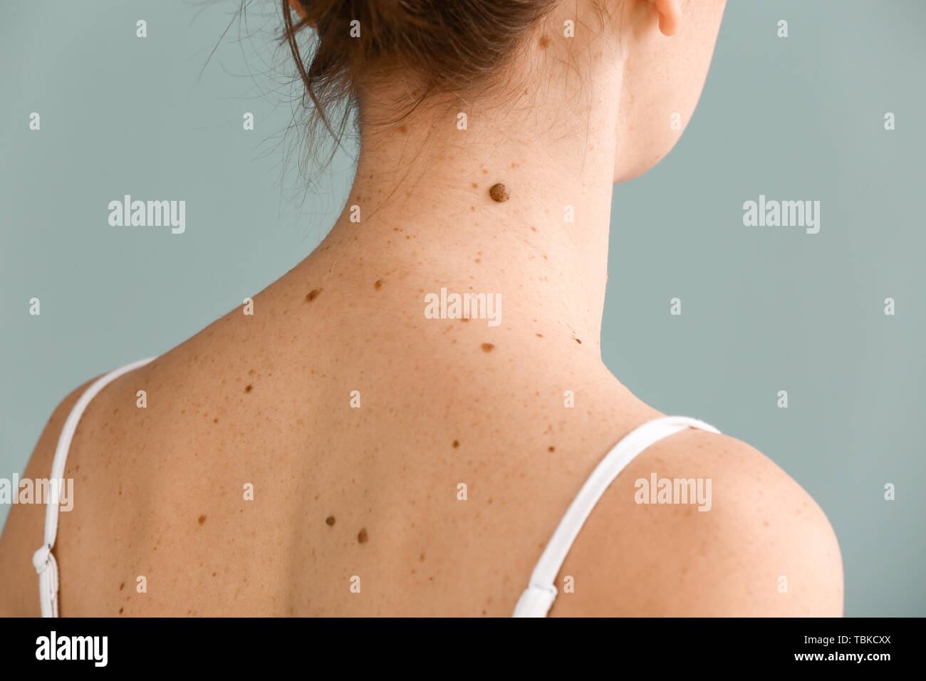 Young woman with moles on grey background Stock Photo - Alamy