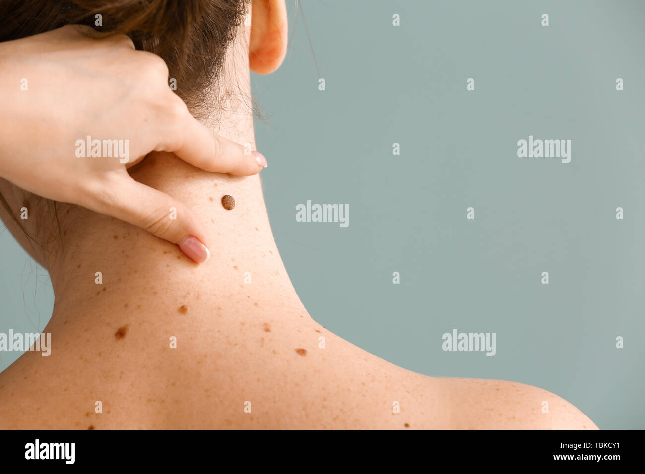 Dermatologist examining moles of patient on grey background Stock Photo ...