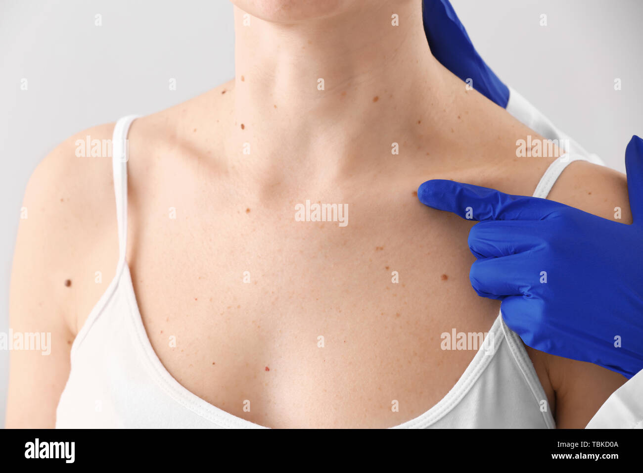 Dermatologist examining moles young hi-res stock photography and images ...