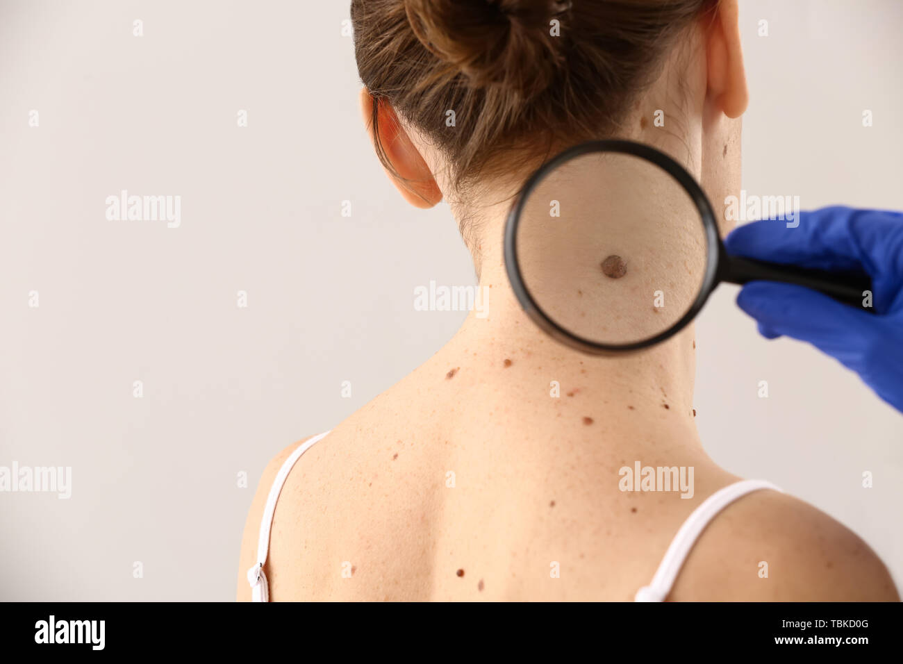 Dermatologist examining moles young hi-res stock photography and images ...