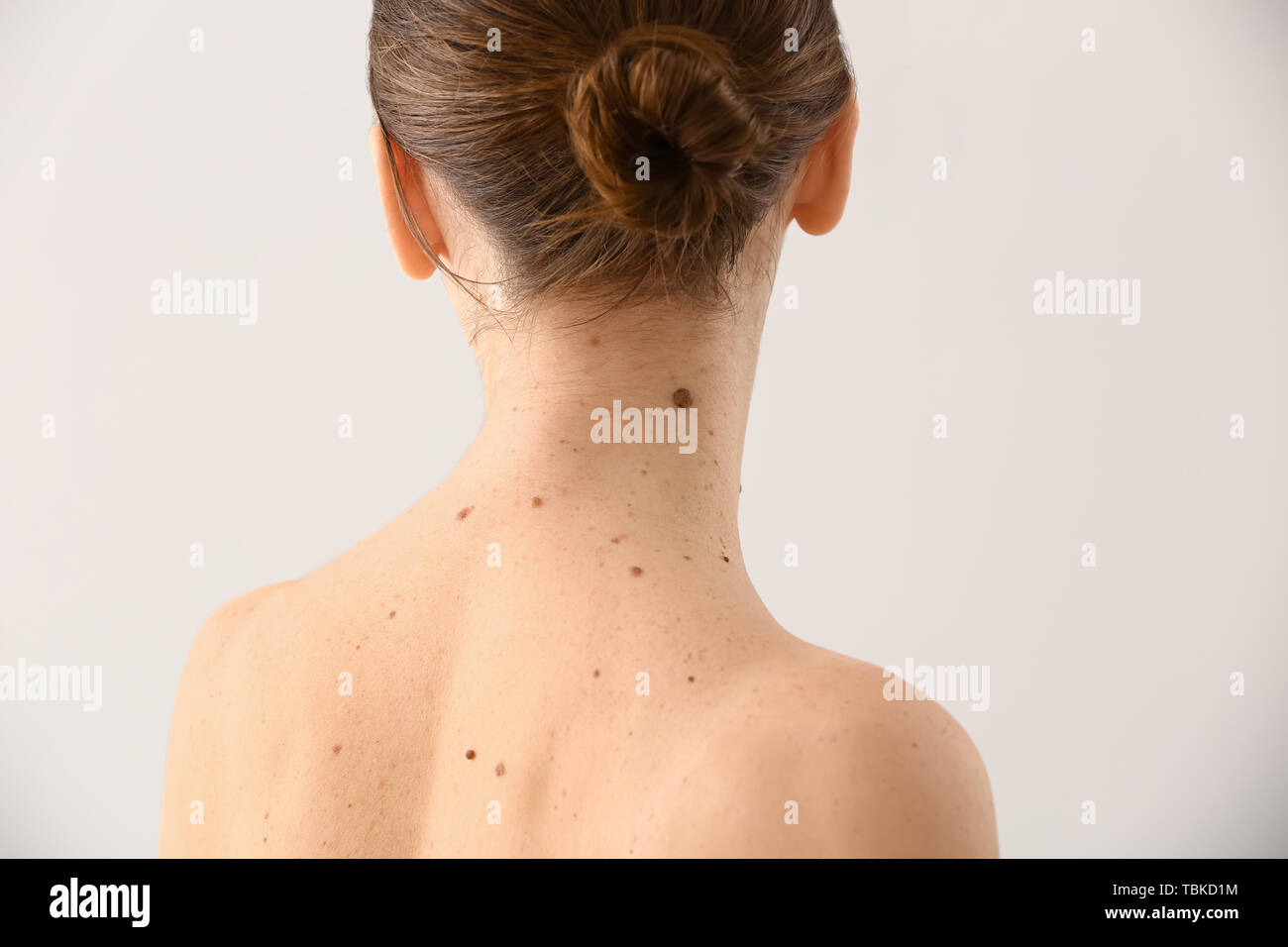 Woman with moles on skin hi-res stock photography and images - Alamy