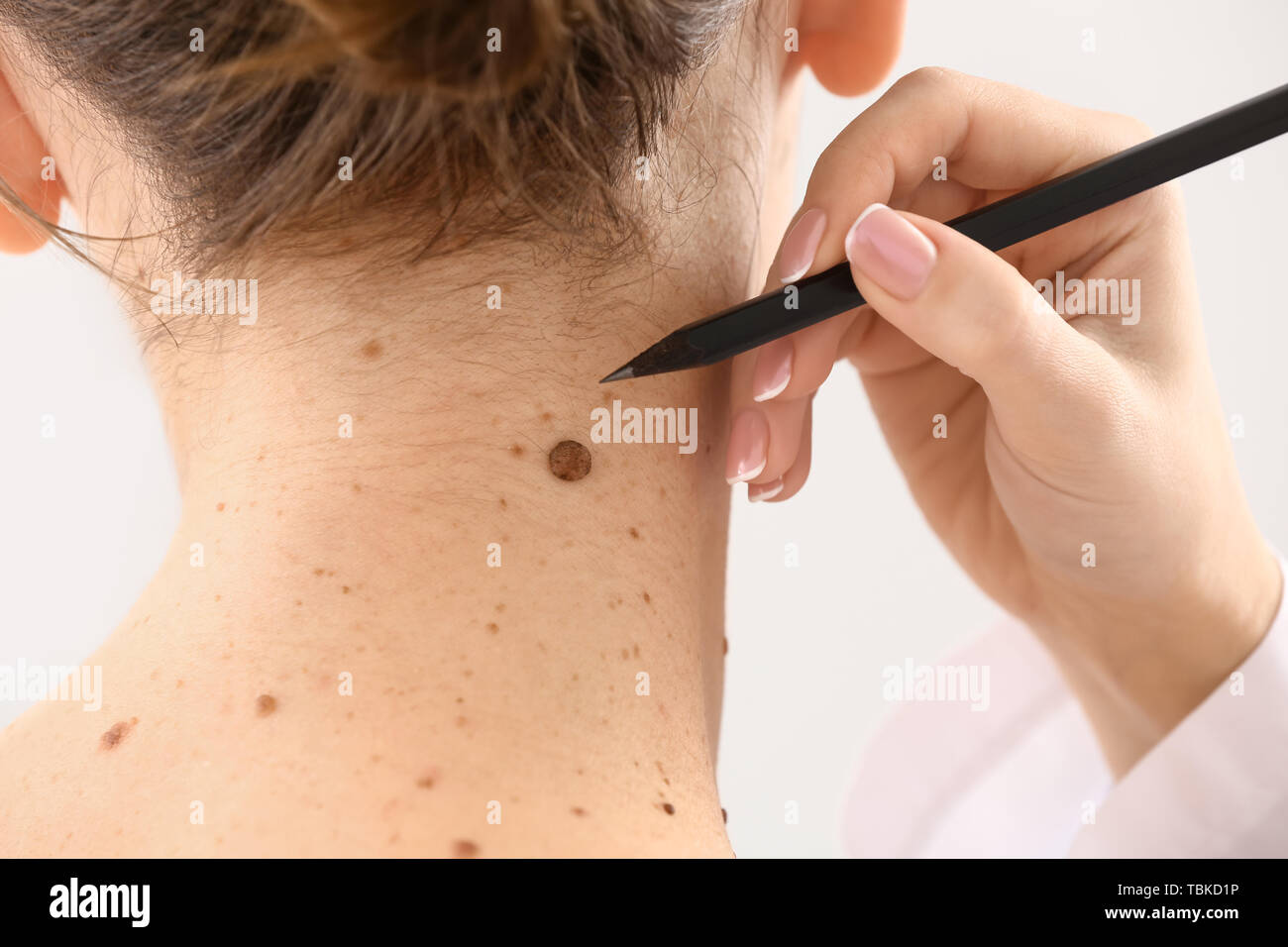Dermatologist applying marks onto patient's skin before moles removal ...