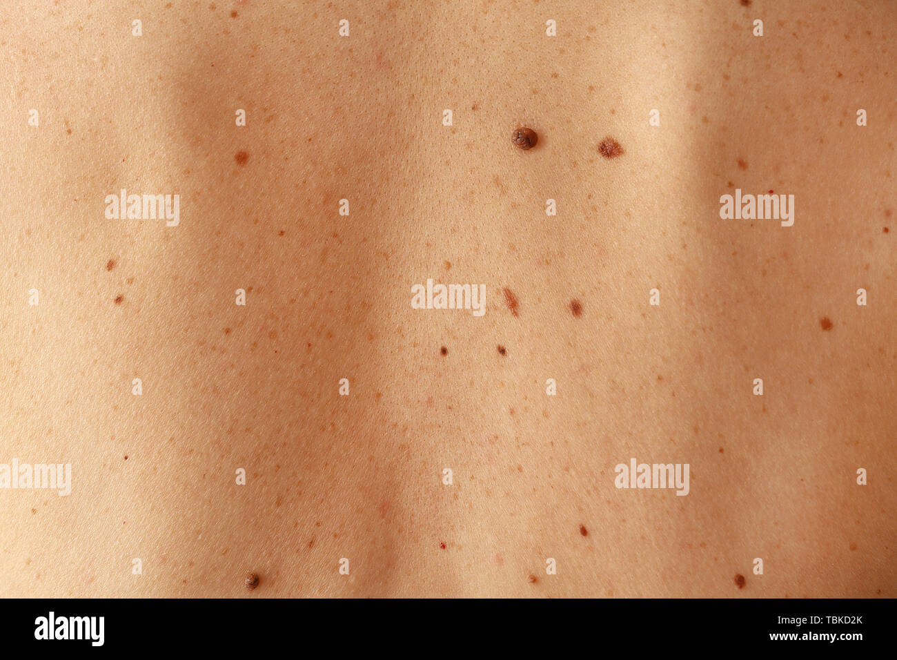Moles back skin hi-res stock photography and images - Alamy