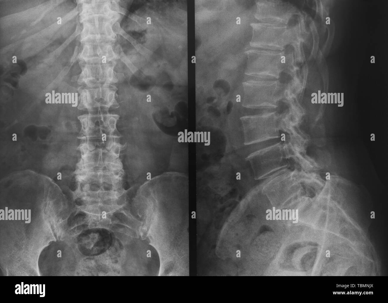 X-ray of the pelvis and spinal column Stock Photo - Alamy