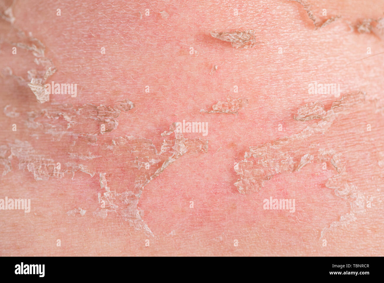 Sunburns of body, closeup. Skin damaged by sun, peeling. Body care ...