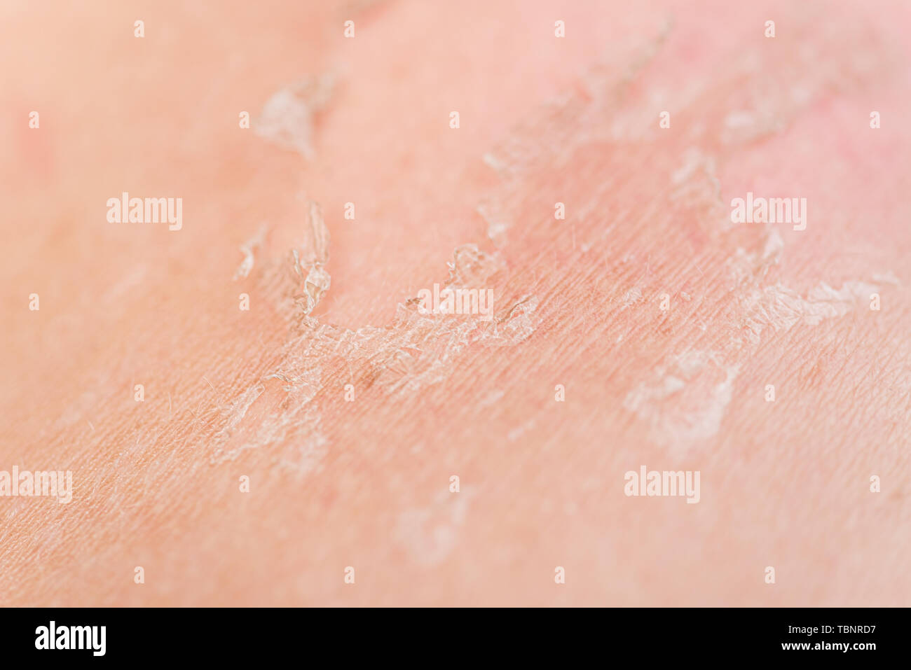 Sunburns of body, closeup. Skin damaged by sun, peeling. Body care ...