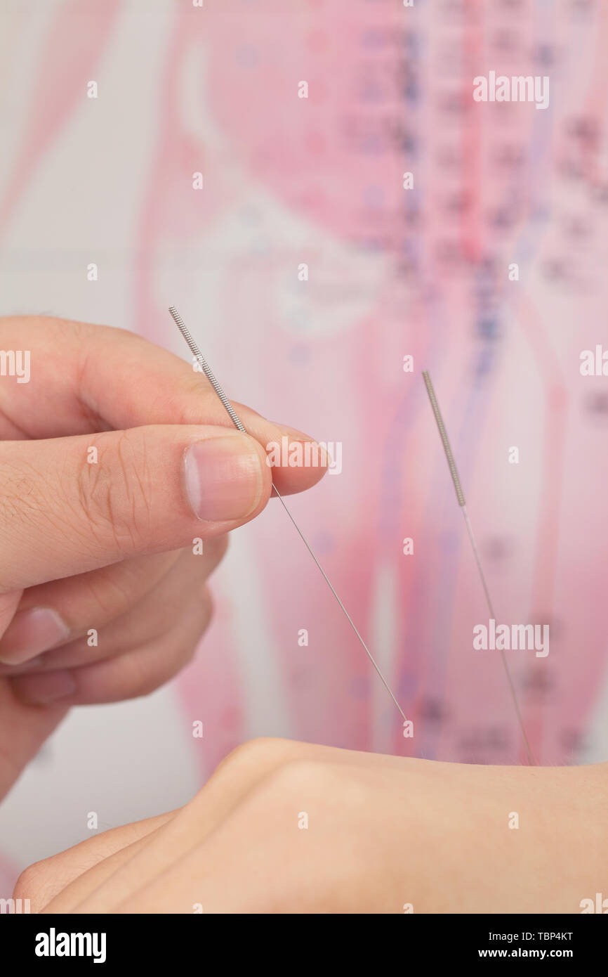 Medical acupuncture hi-res stock photography and images - Alamy