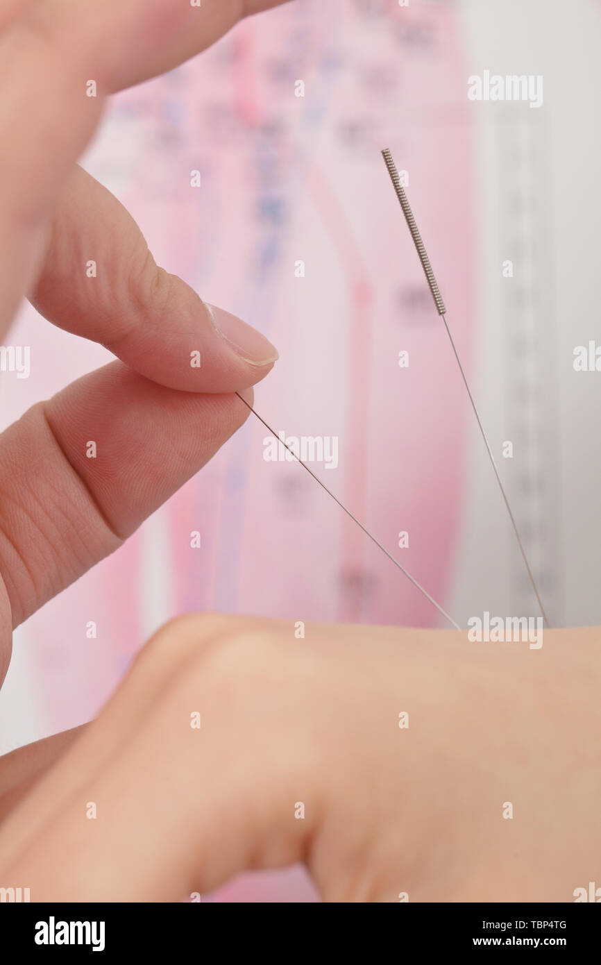 Medical acupuncture hi-res stock photography and images - Alamy