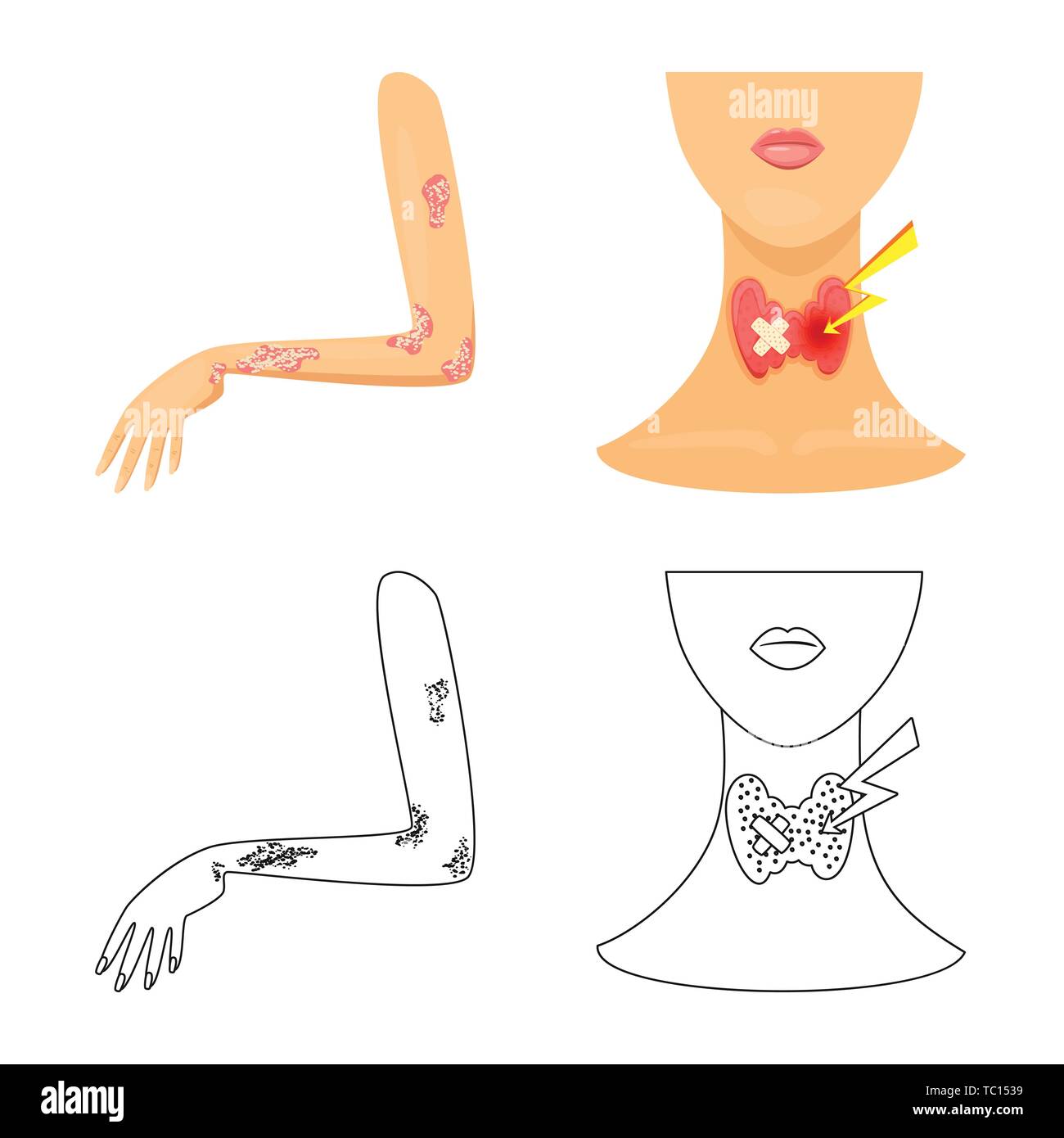 Psoriasis Endocrine Dermatitis System Skin Neck Rash Anatomy Itch Body