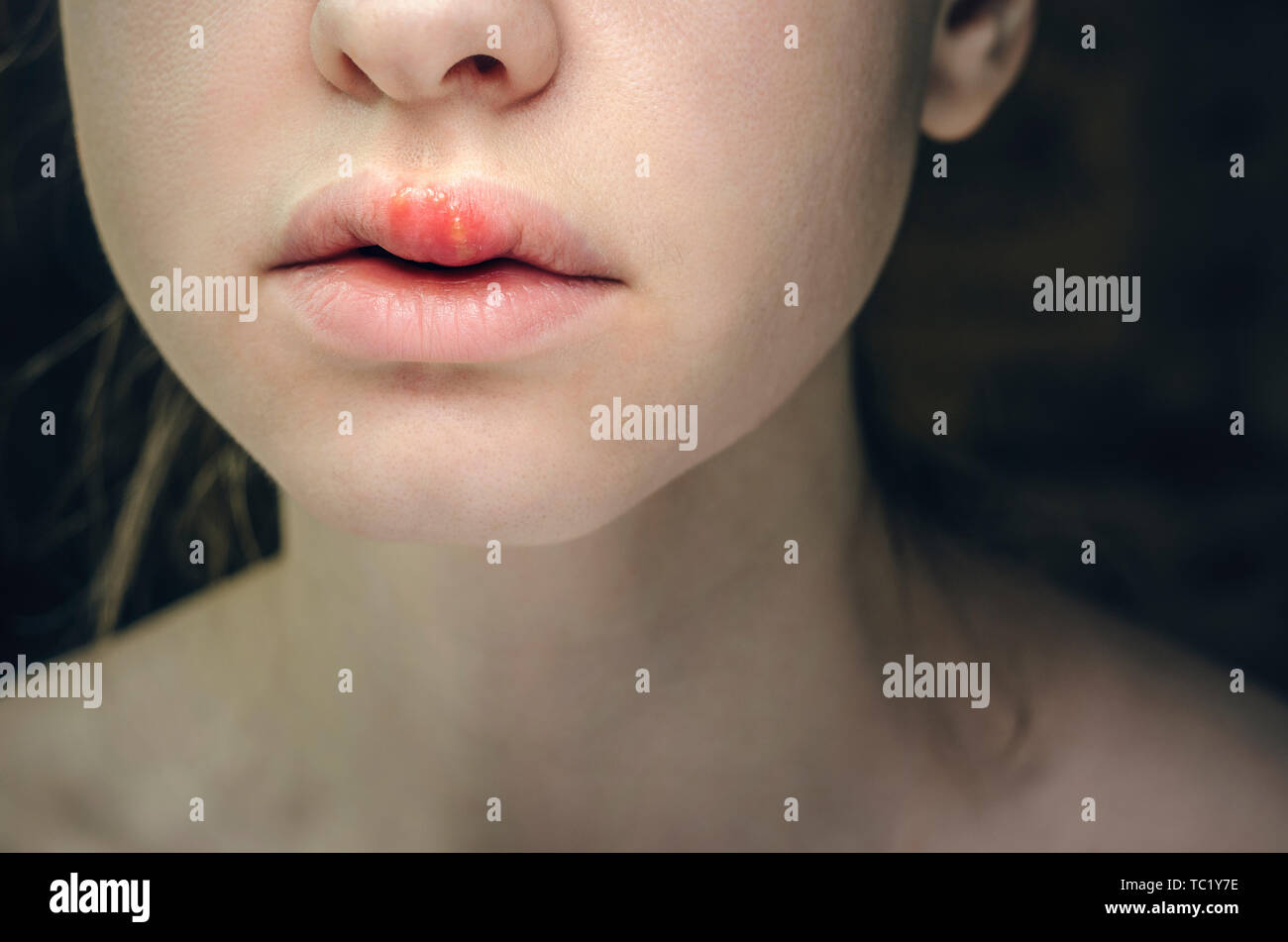 Herpes labialis hi-res stock photography and images - Alamy