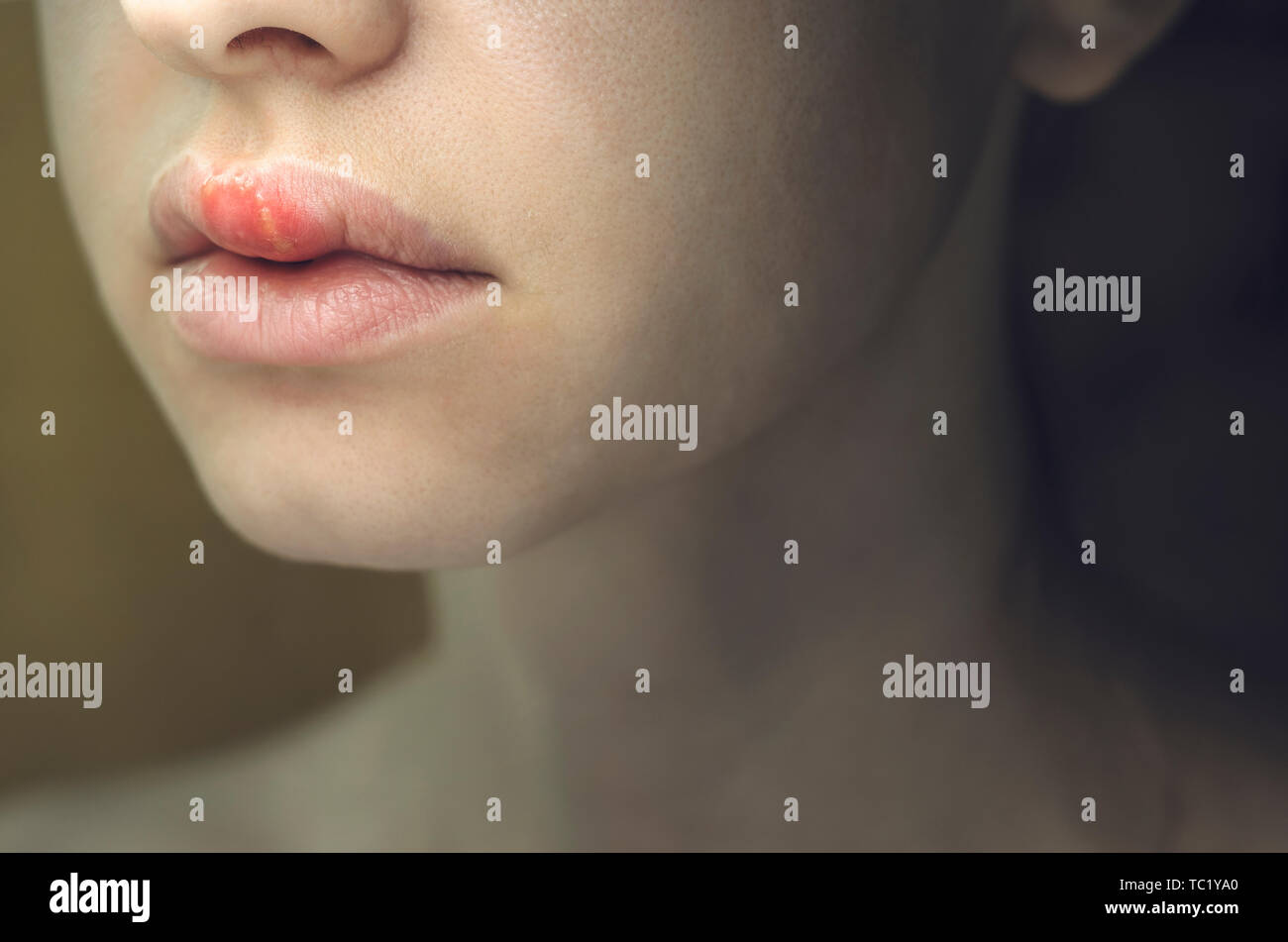 Herpes on the Upper Lip of a Young Woman. Medical Background of a Young ...