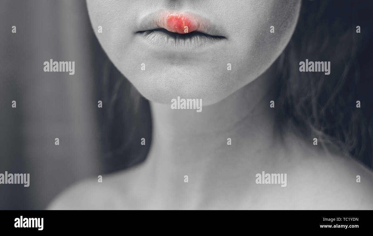 Herpes on the Upper Lip of a Young Woman. Medical Background of a Young ...