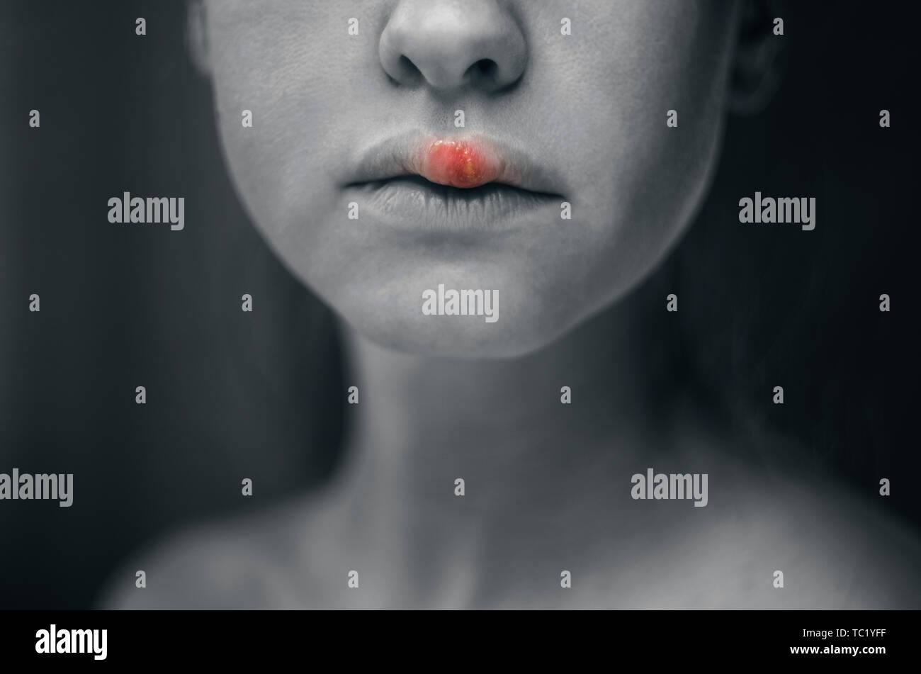 Herpes on the Upper Lip of a Young Woman. Medical Background of a Young ...