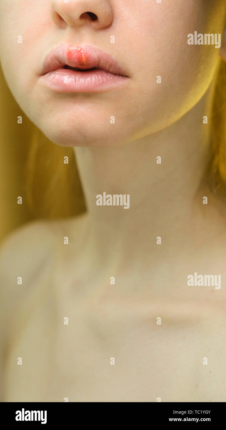 Herpes on the Upper Lip of a Young Woman. Medical Background of a Young ...