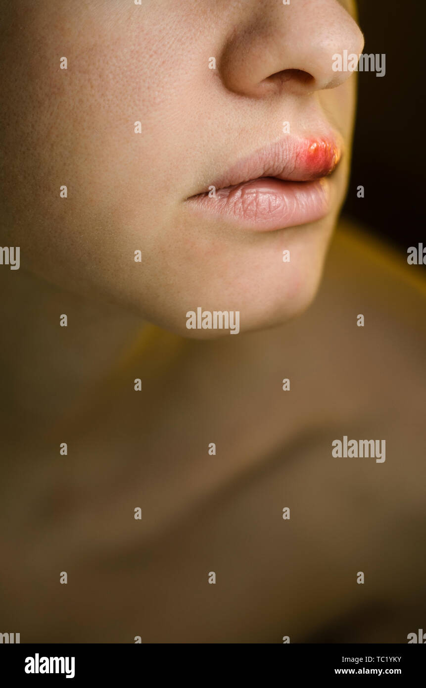 Herpes on the Upper Lip of a Young Woman. Medical Background of a Young ...