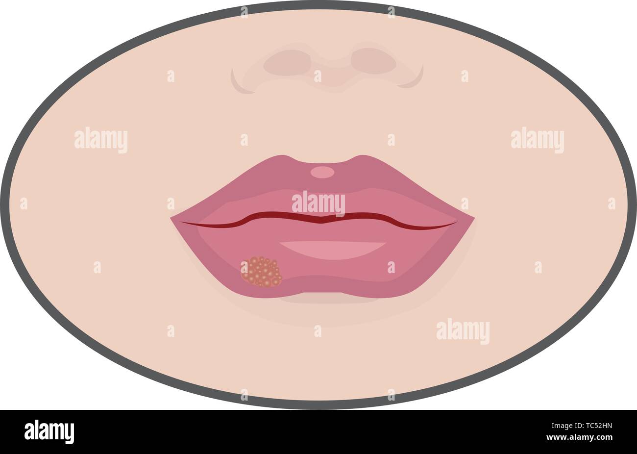 Herpes cold sores on lips vector illustration on a white background ...