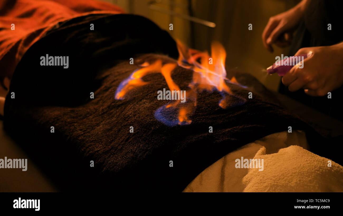 Chinese fire massage and therapy Stock Photo - Alamy