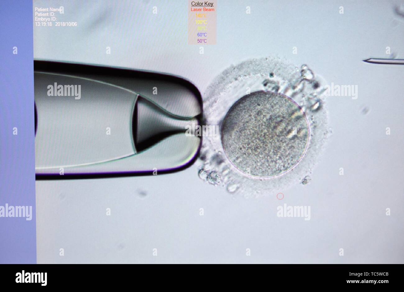 Ivf hi-res stock photography and images - Alamy