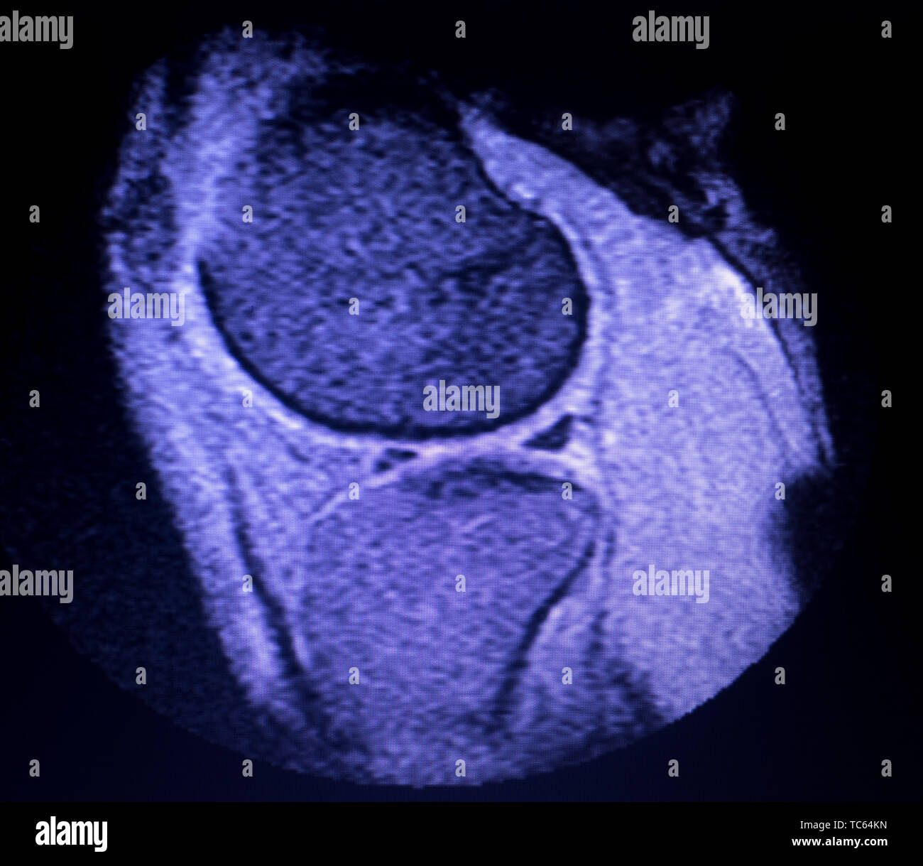 Magnetic resonance imaging MRI knee posterior horn medial meniscus tear ...