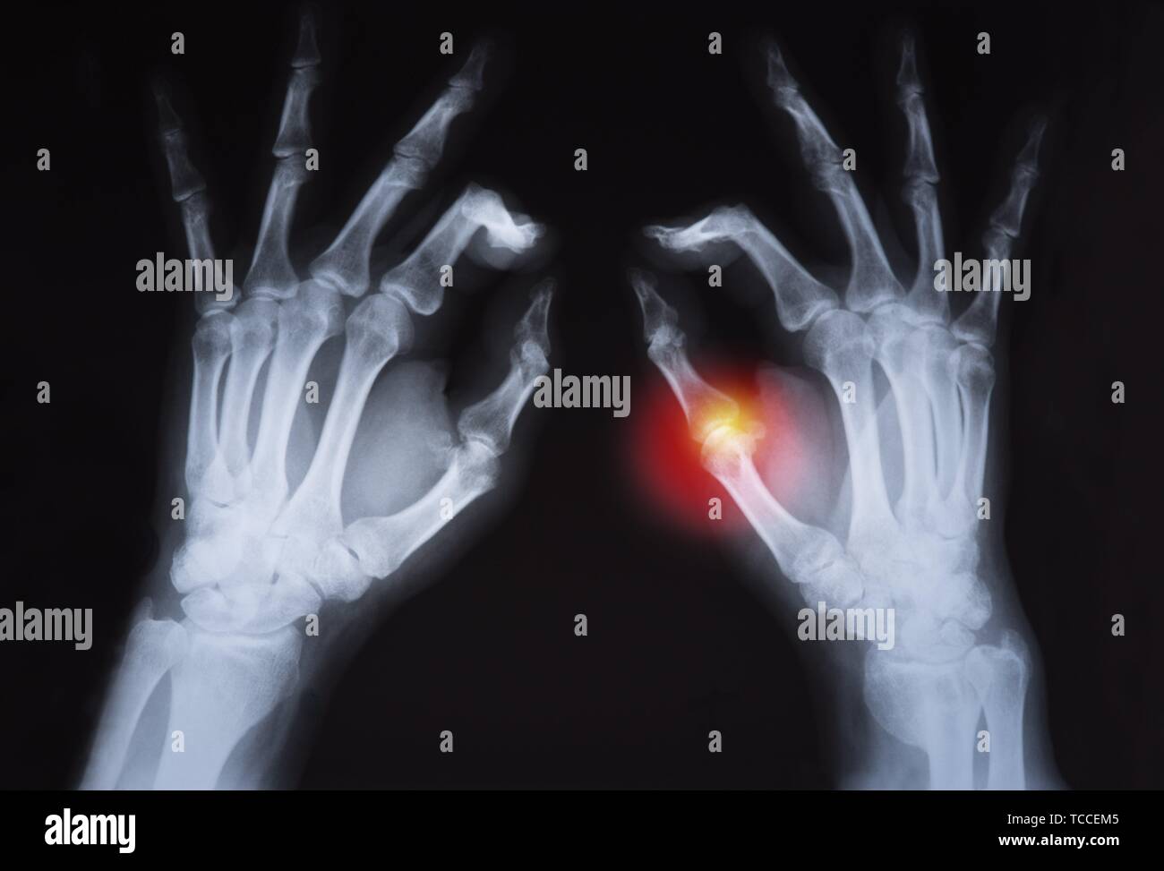 Rheumatoid arthritis hands x ray hi-res stock photography and images ...