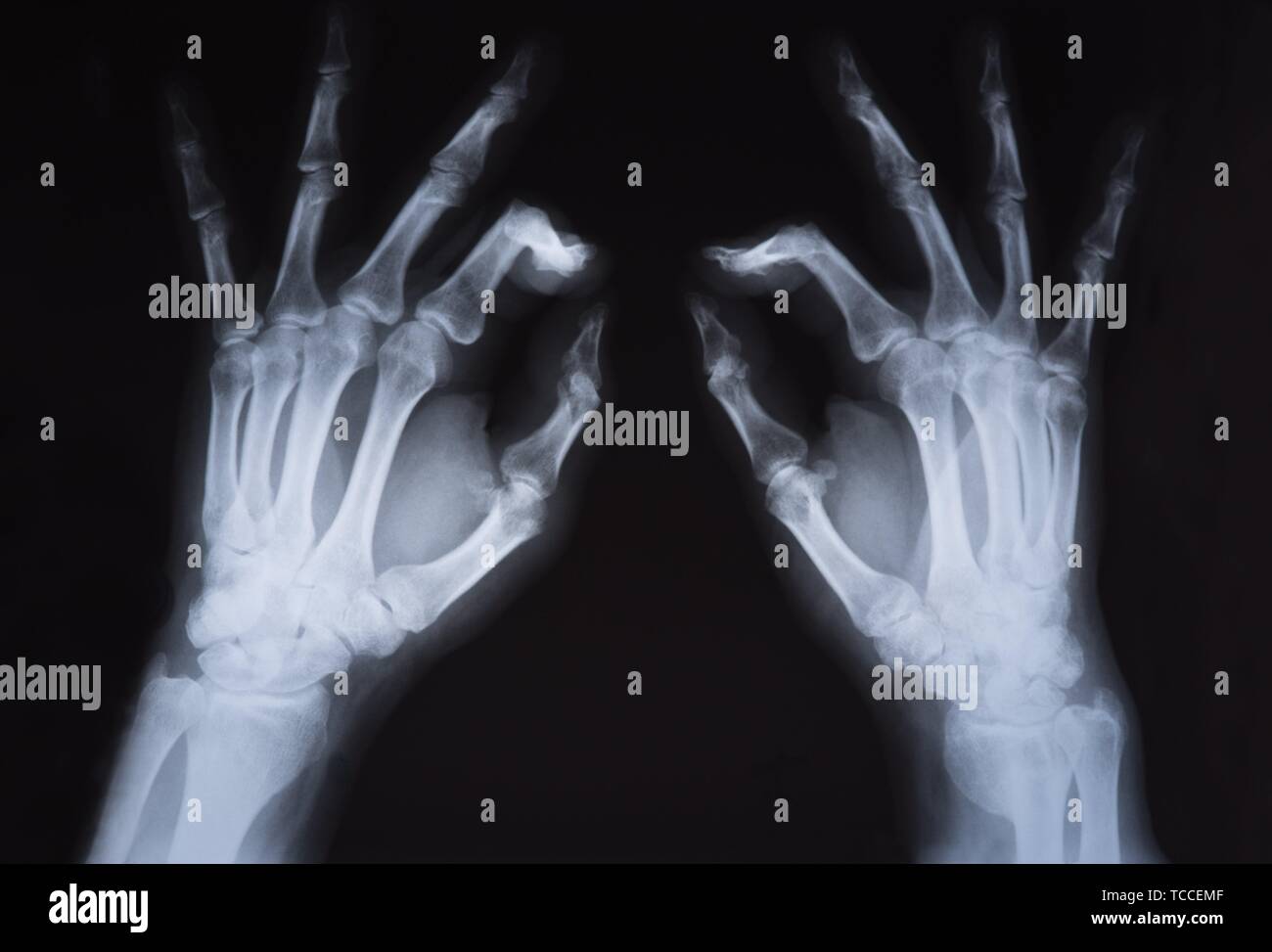 Broken hand x ray hi-res stock photography and images - Alamy