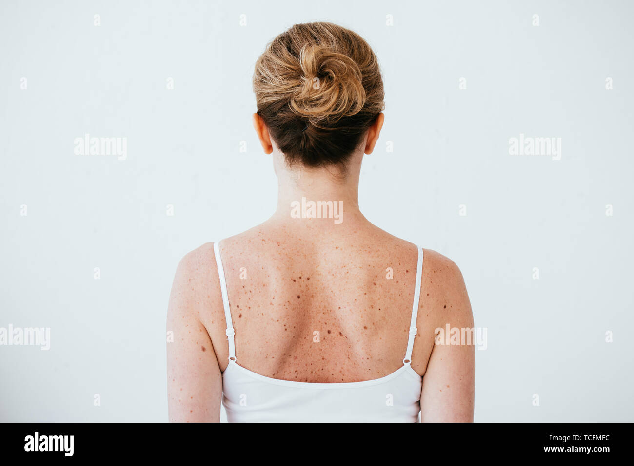 Melanoma of the skin hi-res stock photography and images - Alamy