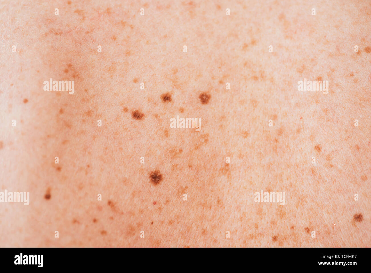 Moles and melanoma hi-res stock photography and images - Alamy