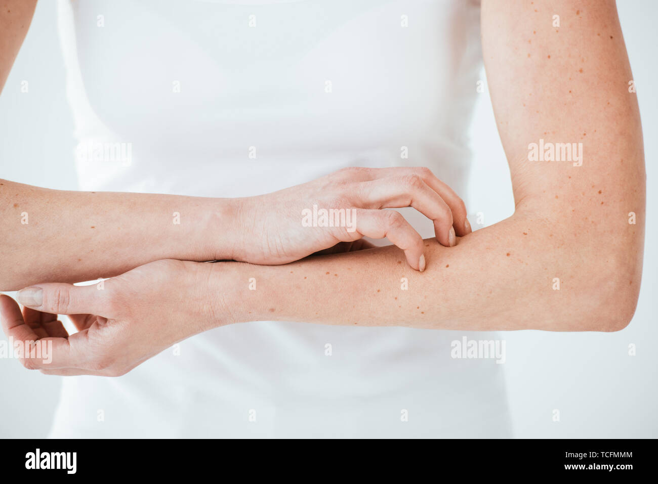 cropped view of allergic woman scratching hands on white Stock Photo ...