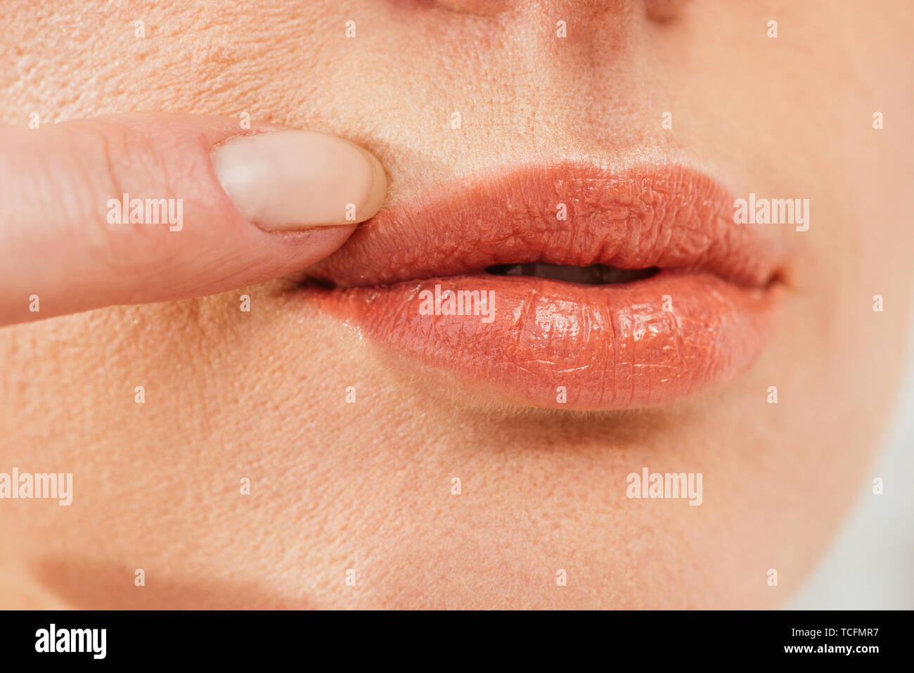 cropped view of sick woman touching herpes on lips Stock Photo - Alamy