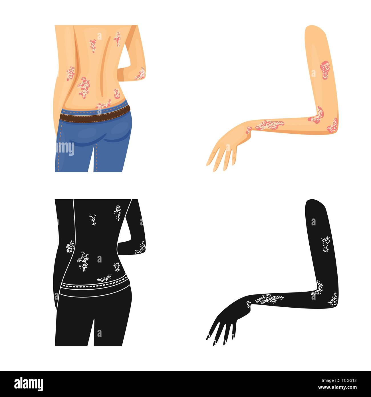 psoriasis,skin,dermatitis,body,eczema,rash,allergy,itch,stress,sick ...