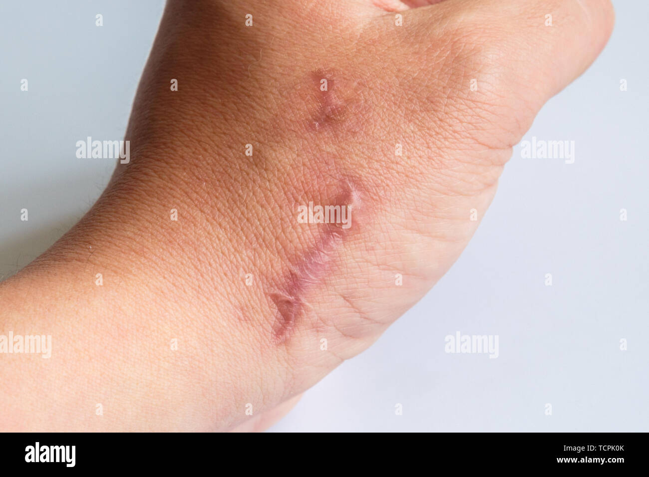 The scar on his arm near the wrist on a white background. Two scars ...