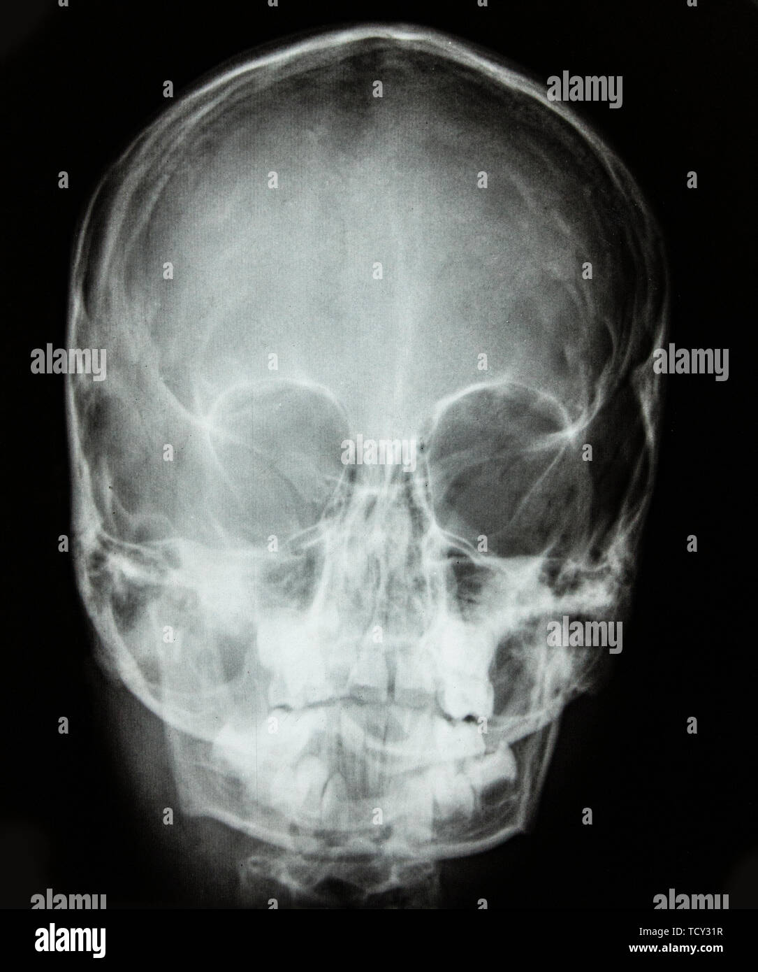Skull X Ray Front