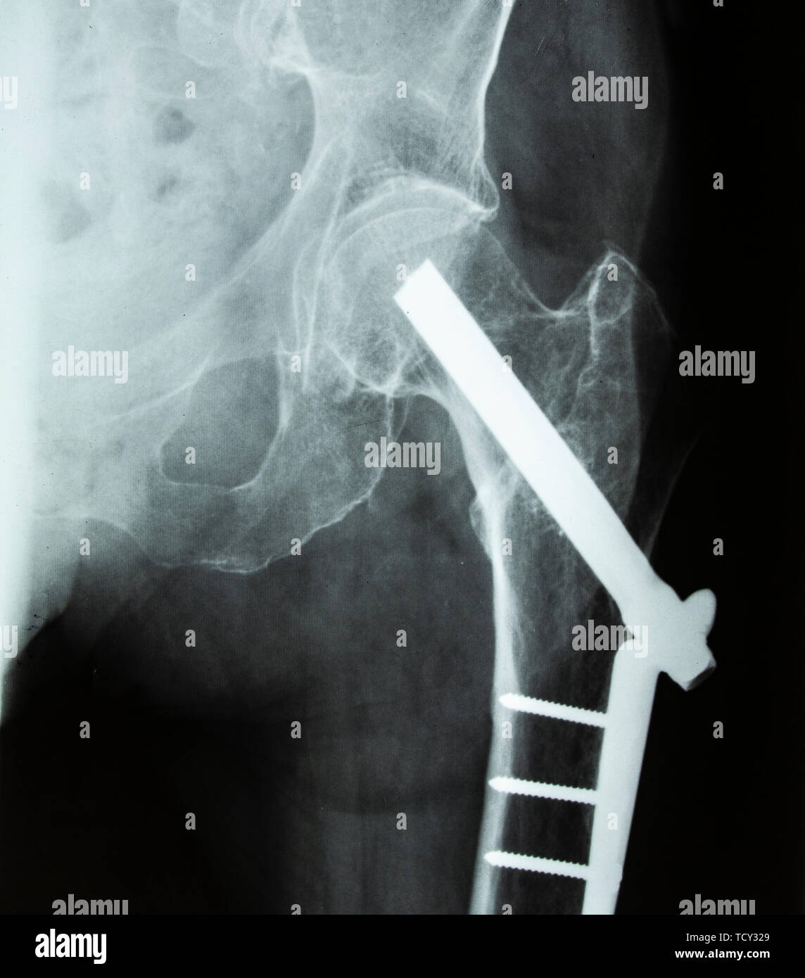 Hip joint anatomy hi-res stock photography and images - Alamy