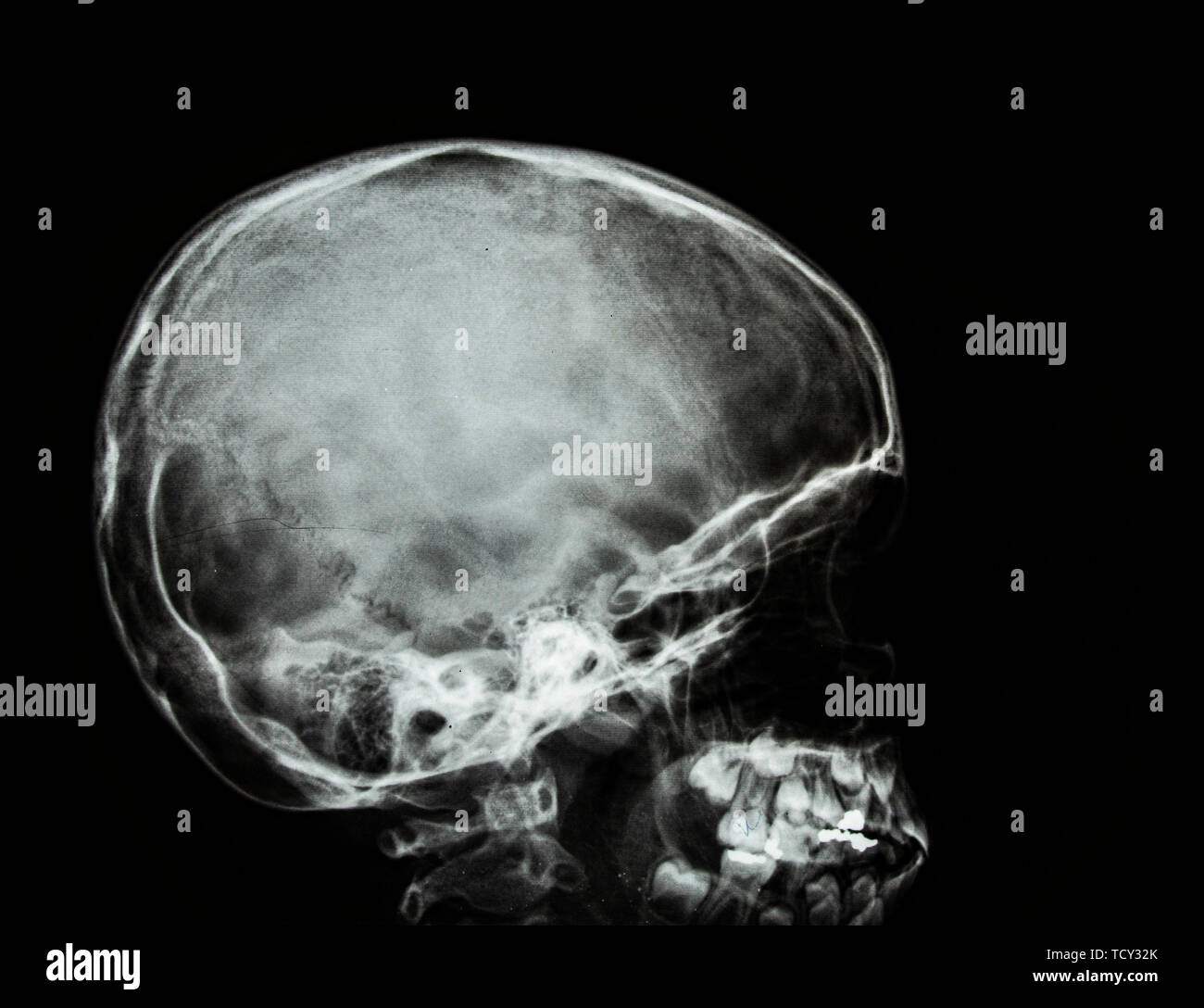 Lateral skull hi-res stock photography and images - Alamy