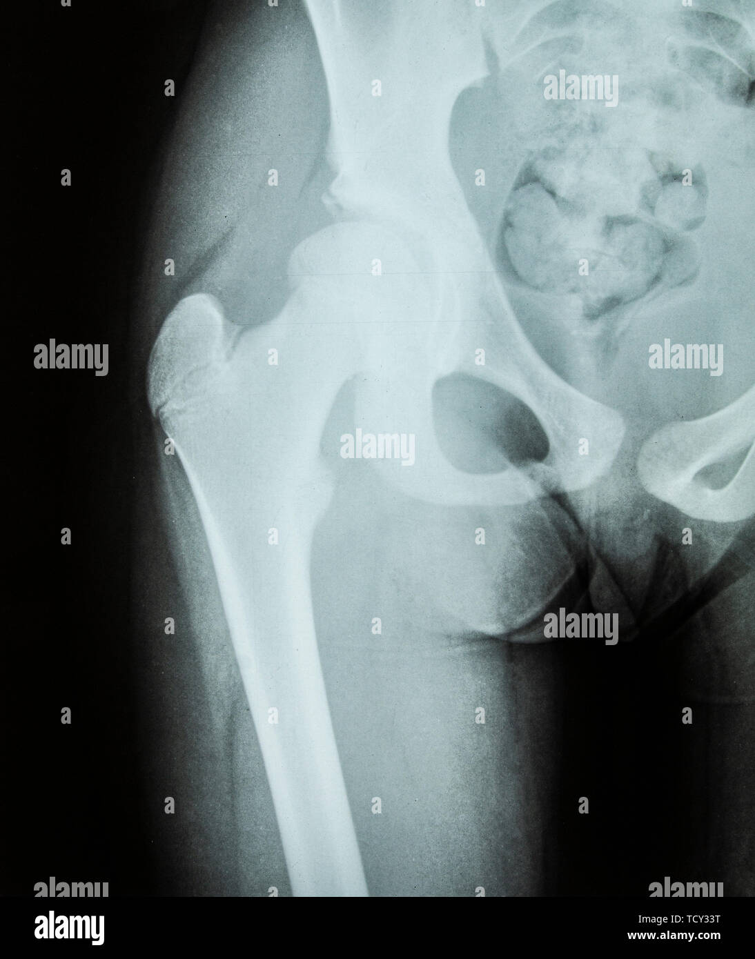 Pelvis Anatomy High Resolution Stock Photography and Images - Alamy